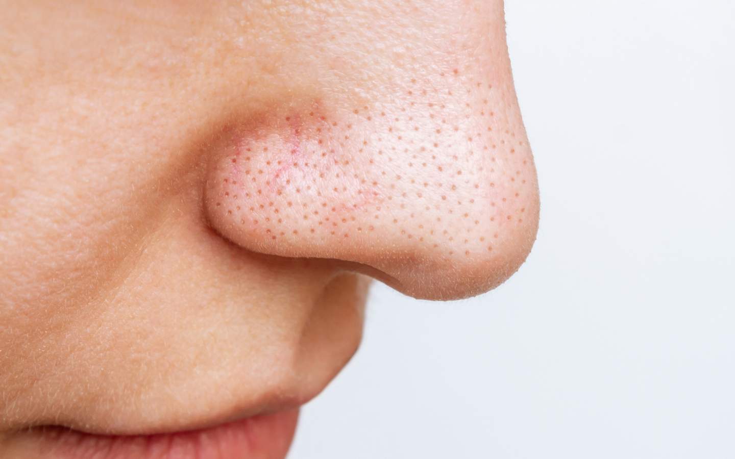 What Are Sebaceous Filaments And How To Get Rid Of Them Alkmene What Are Sebaceous Filaments And How To Get Rid Of Them Alkmene