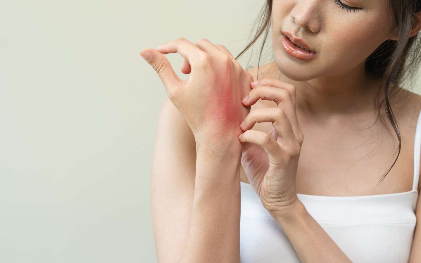 Seborrhoea and sebostasis- alkmene